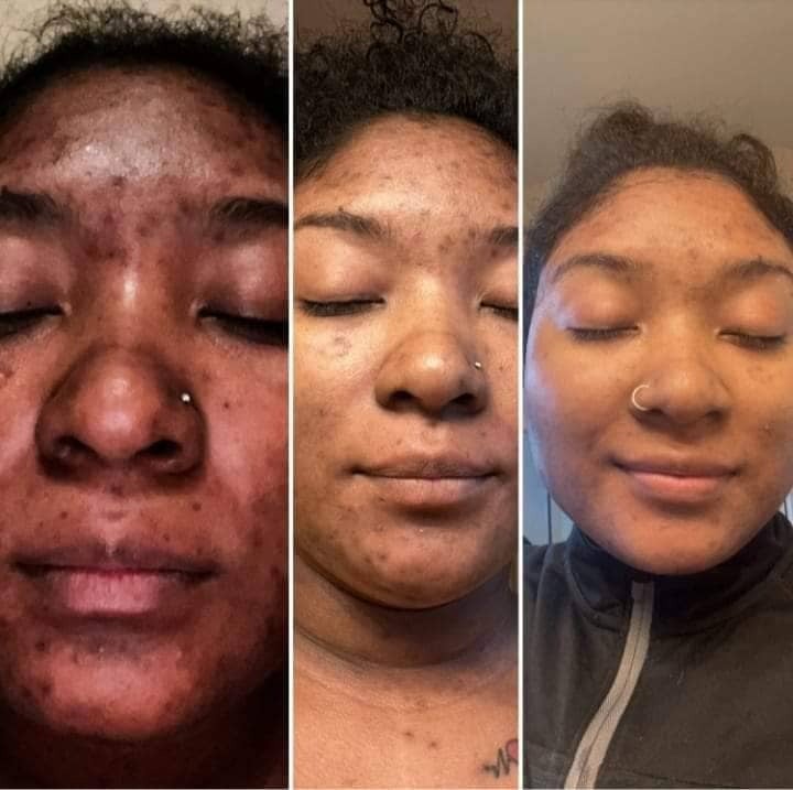 Molato Soap,with Salicylic Acid,Licorice &Saffron and African Black ...